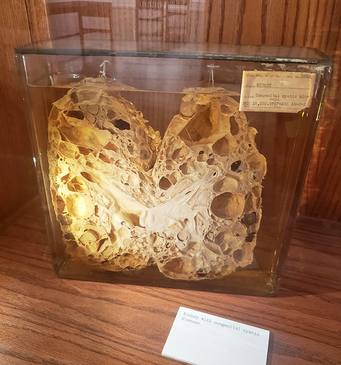 This preserved kidney specimen with congenital cystic disease looks strangely beautiful &ndash; like nature's version of a geode cut open to reveal its secrets.